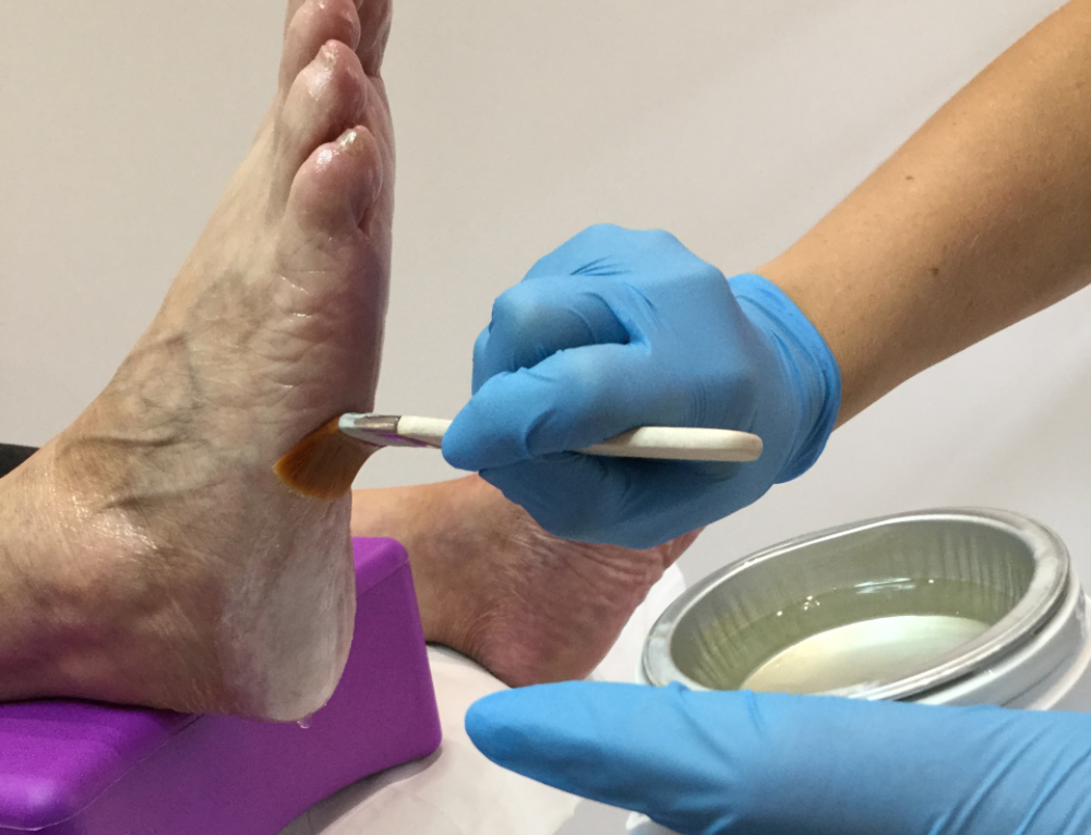 Curly Toes?… [Adductovarus Deformity of the 4th or 5th Toe] – Care For Feet